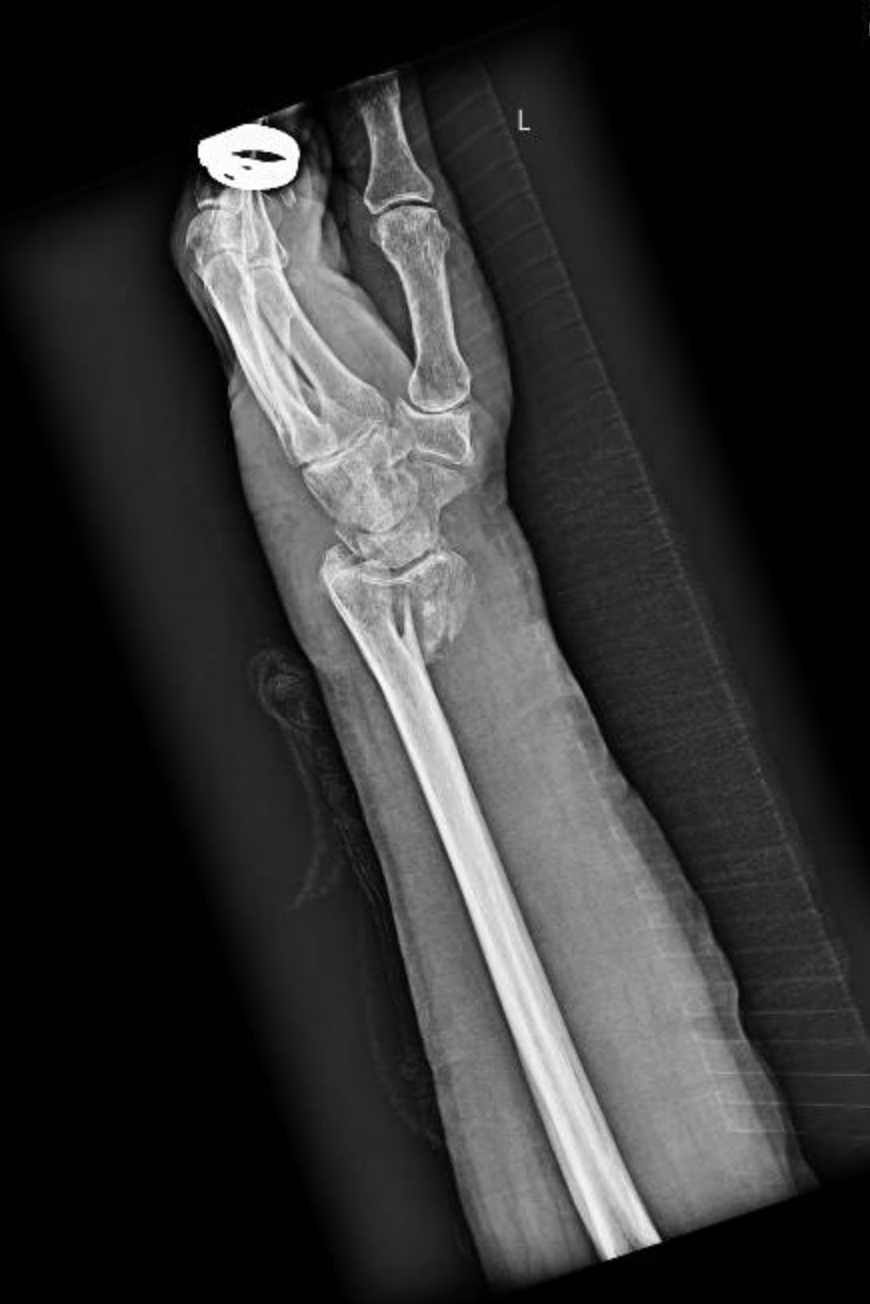 Distal Radius Fractures Dr Oscar Brumby Rendell Adelaide