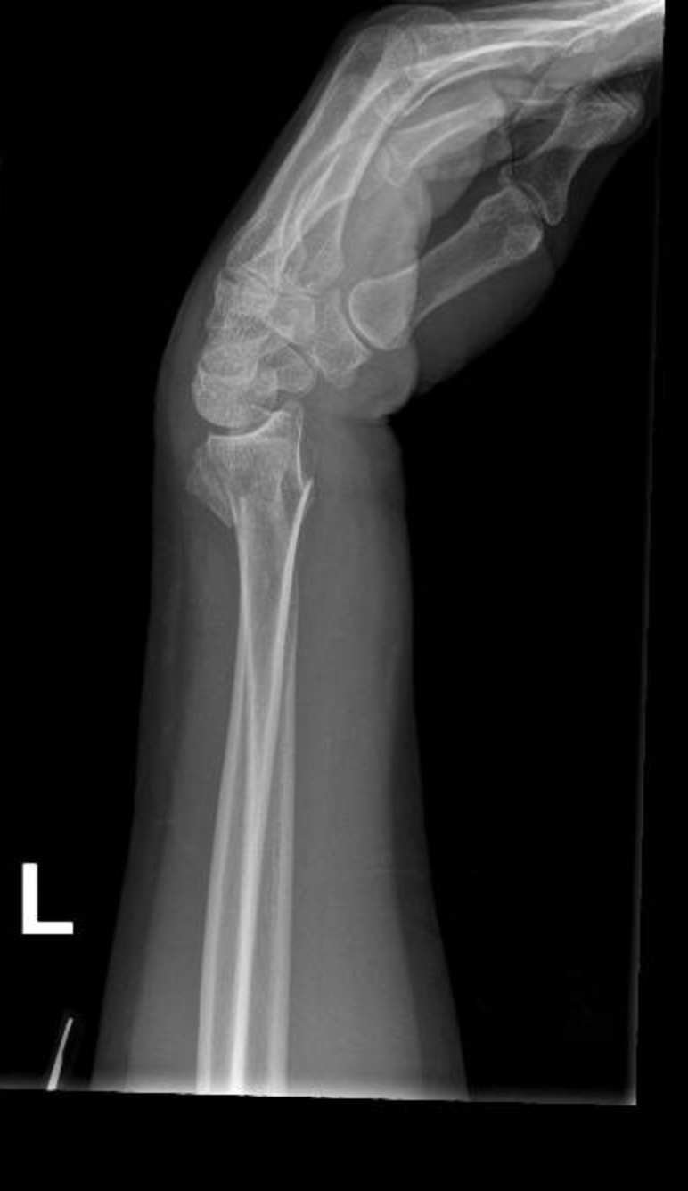 Distal Radius Fractures | Dr Oscar Brumby-Rendell | Adelaide