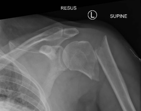Proximal Humerus Fractures | Dr Oscar Brumby-Rendell | Adelaide