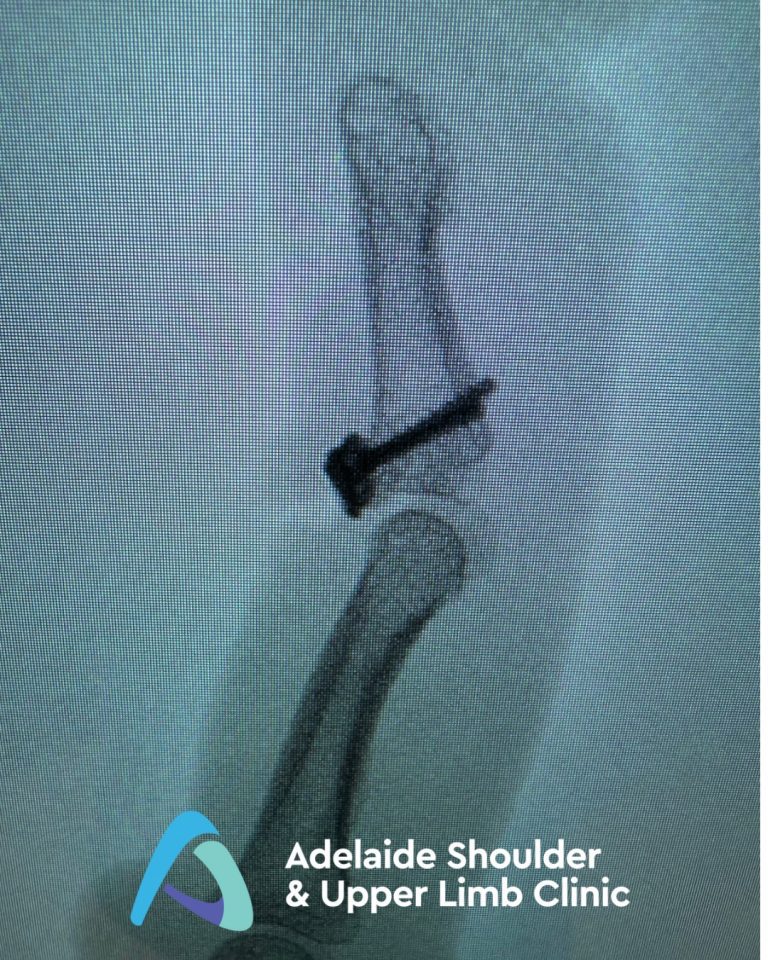 Hand Fractures | Dr Oscar Brumby-Rendell | Orthopaedic Surgeon Adelaide