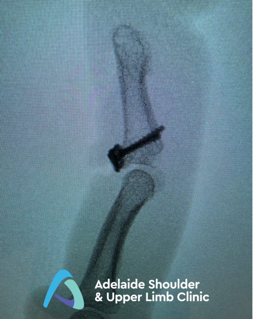 Hand Fractures | Dr Oscar Brumby-Rendell | Orthopaedic Surgeon Adelaide