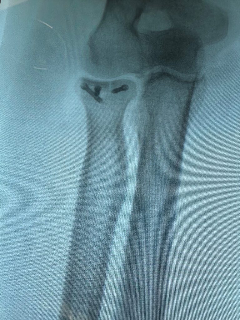 Fractures Around the Elbow | Dr Oscar Brumby-Rendell | Orthopaedic Surgeon