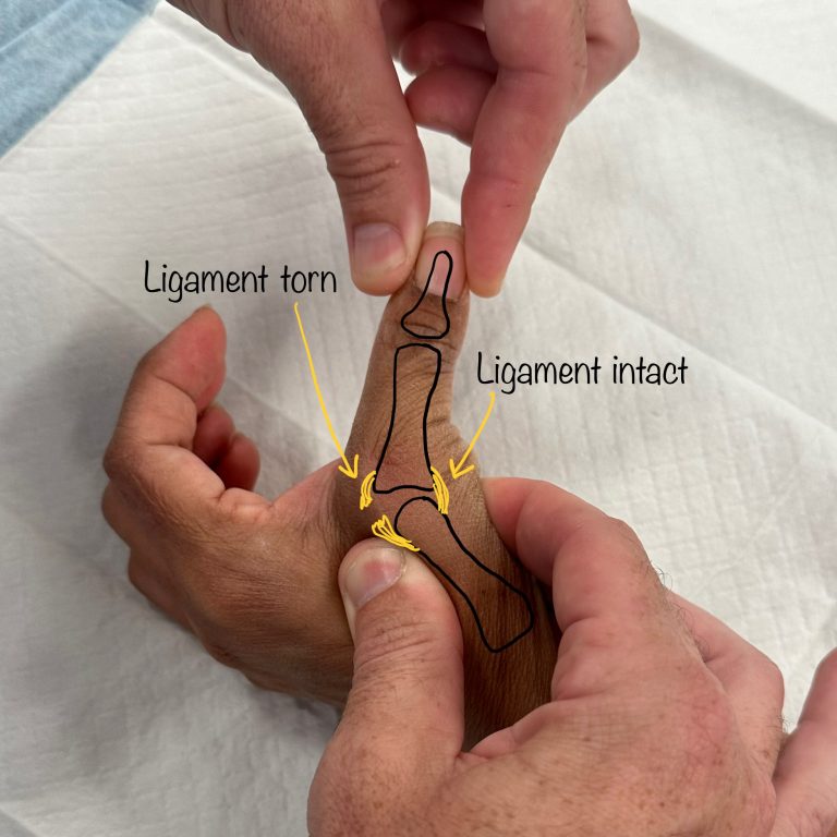 Thumb Ulnar Collateral Ligament (UCL) Repair | Dr Oscar Brumby-Rendell | Orthopaedics